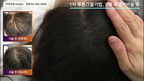 탈모 두피문신 연세미다인 투톤그물기법 Youtube