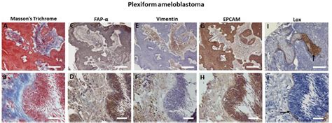 Plexiform Ameloblastoma Histology