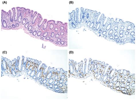 Efficient Long Term Depletion Of Cd20 B Cells By Rituximab Does Not