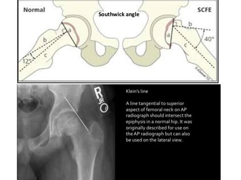Lines And Angles In Orthopedics Epomedicine