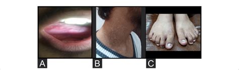A Leukoplakia B Reticulated Hyperpigmentation Over The Side And