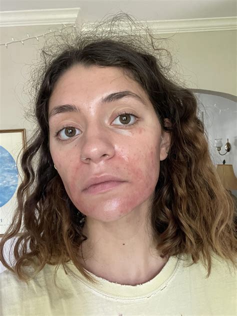 It Gets Better — Doxycycline R Perioral Dermatitis