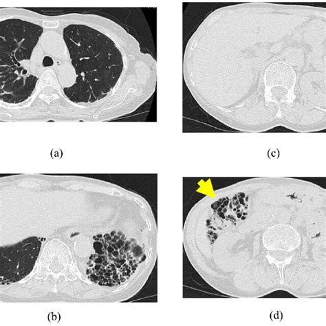 Chest Ct A Showing Nodular And Bronchiectatic Lesions In The Right Download Scientific