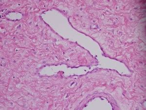 Juvenile Nasopharyngeal Angiofibroma Ken U Ekechukwu Md Mph Facp