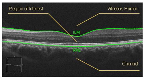 Diabetic Macular Edema Characterization And Visualization Using Optical