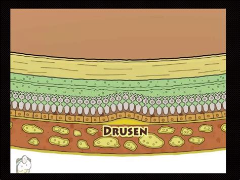 Age Related Macular Degeneration Pptx