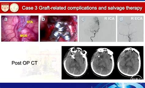 朱巍教授：以大脑前动脉a1为供血支的颅内搭桥术式及其优势 脑医汇