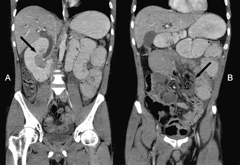 A Patient With Biliary Colic And Intestinal Obstruction Gut