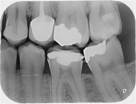 Routine Bitewing X Rays For Dental Health Nick Dental