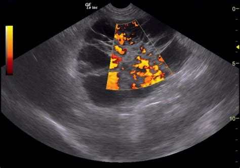 Progressive Hepatic Cyst Members