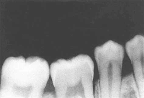 Periapical Technique Errors Flashcards Quizlet