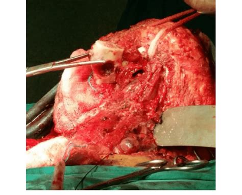 Right Segmental Mandibulectomy Was Performed Because There Were Download Scientific Diagram