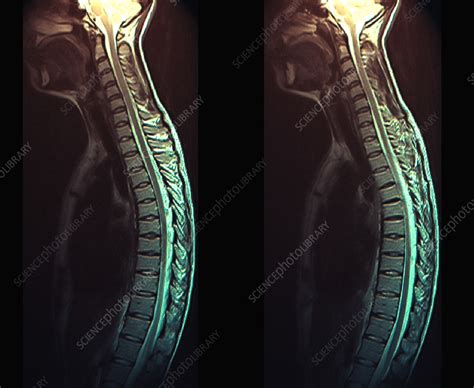 Normal Spinal Mri Detection Of Spinal Cord Multiple Sclerosis Lesions