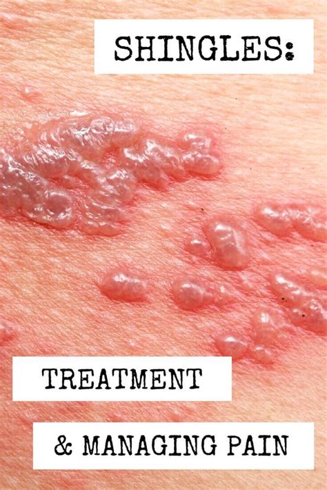 Itching Shingles Rash Treatment At Dawn Jenkins Blog