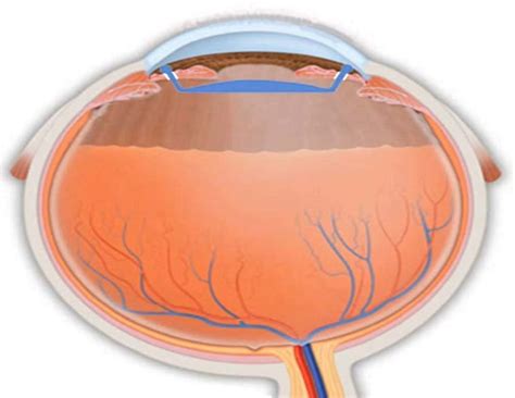 Diagrammatic Cross Section Of The Eye Showing The Position Of The New
