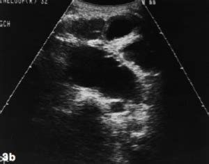 Emergency Medicine Educationultrasound For Small Bowel