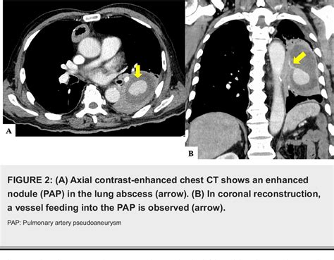 Figure 2 From Infectious Pulmonary Artery Pseudoaneurysm Secondary To A