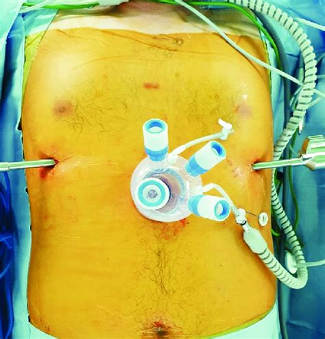 Typical Port Placement For 3 Arm Robotic Thymectomy Via The Subxiphoid Download Scientific