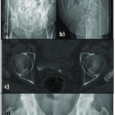 Pelvimetry Performed Using Conventional Radiography Included With