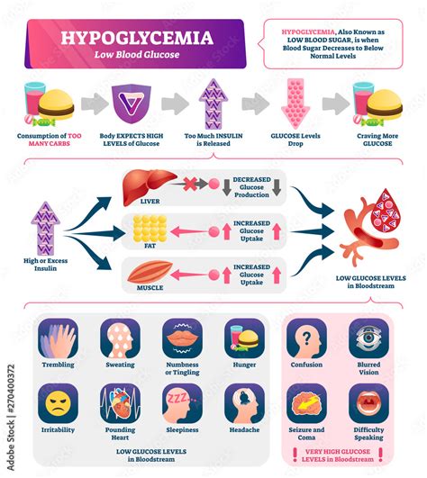 Hypoglycemia Vector Illustration Labeled Low Sugar Level Medical
