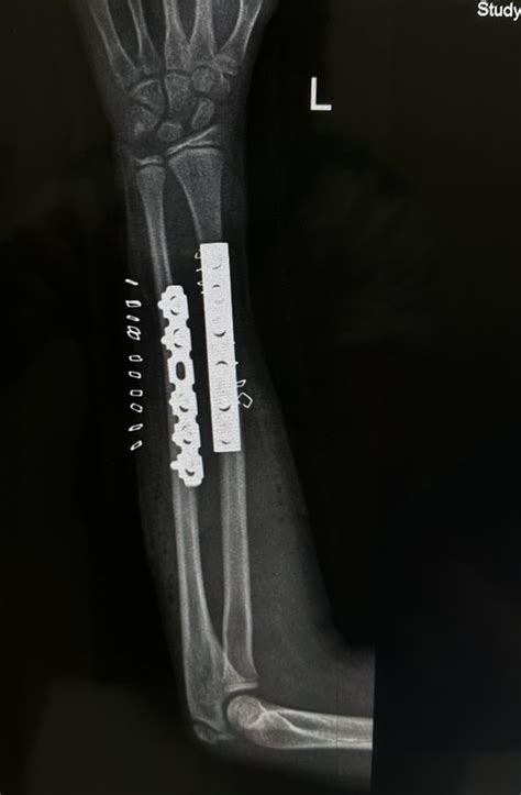 Sp Orif Plating M3rd Radius And Ulna Left Rradiology