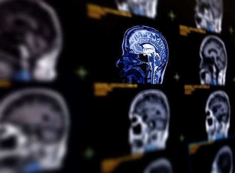 Brain Aneurysms Symptoms Causes Prognosis And More