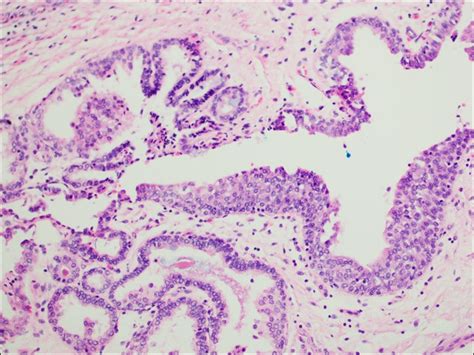 Prostate Normal Histology Nus Pathweb Nus Pathweb