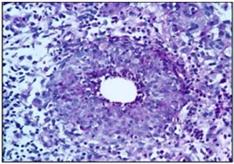 Breast Tuberculosis Masquerading As Malignancy Sidvi