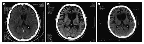 Ct Scans Showing Rapidly Progressive Atrophy Of Frontal And Temporal Download Scientific