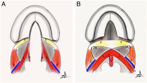 Illustration Of The Modified Restoration Of Tensor Veli Palatini A Download Scientific