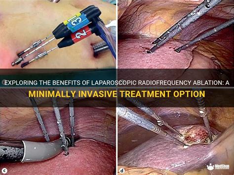 Exploring The Benefits Of Laparoscopic Radiofrequency Ablation A Minimally Invasive Treatment