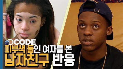 감동주의 남자친구에게 피부병을 고백했습니다 Dcode Youtube