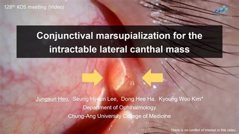 [korean Narration] Conjunctival Marsupialization 128th Kos Meeting