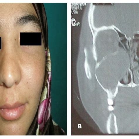 Endoscopic Marsupialization Of The Maxillary Sinus Mucocele Download Scientific Diagram