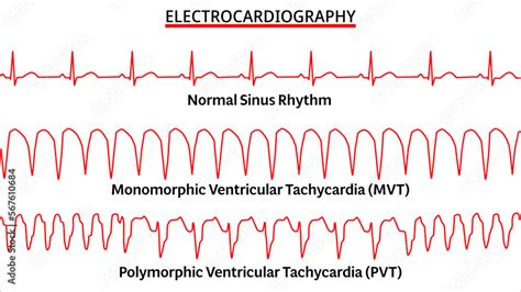 Polymorphic Ventricular Tachycardia