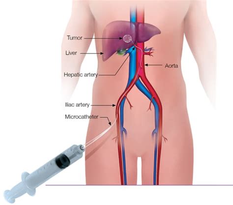 About Lipiodol Guerbet Lipiodol