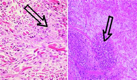 A Case 1 Focal Areas Of Necrosis In The Dermis Accompanied By