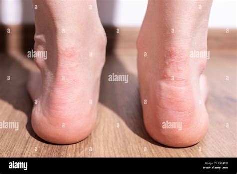 Closeup Allergic Contact Dermatitis On Foot Ankle Heel Caused By