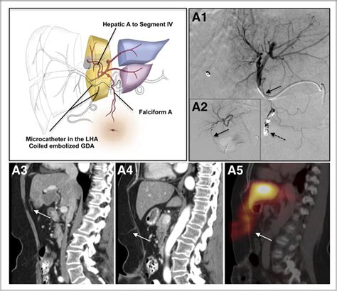 Extrahepatic Perfusion Via Falciform Artery At Top Left Is Anatomic Download Scientific