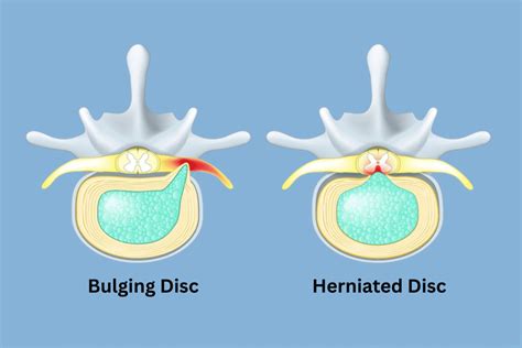 Differente Between Bulging And Herniated Disc Archives Spine
