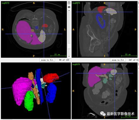 Abdomen2015——腹部13类器官分割案例实现（续） 腾讯云开发者社区 腾讯云