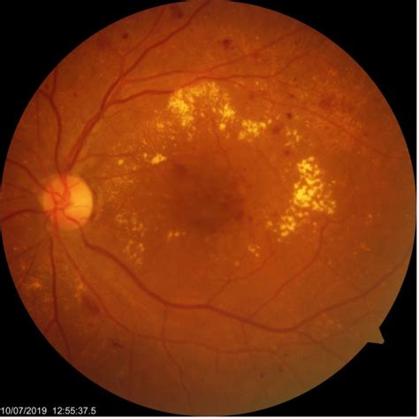 How To Quickly Read A Macular OCT Scan