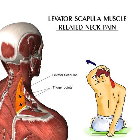 Levator Scapulae Trigger Points