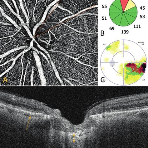 48 Year Old Man With Gon А ОcТА Radial Peripapillary Plexus B A