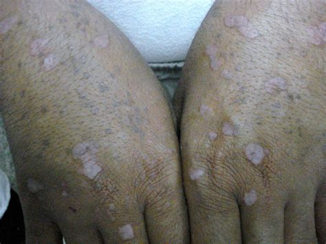 Global Skin Atlas Diagnosis Detail