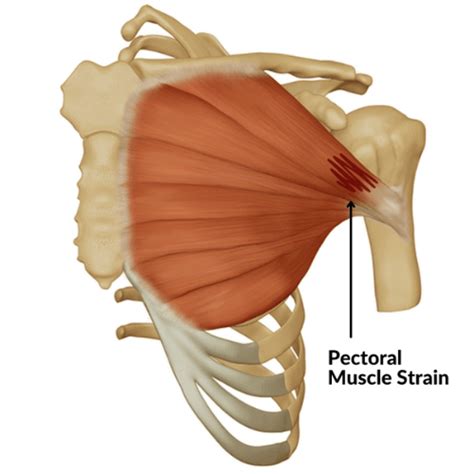 Pectoral Muscle Strain Treatment Chest Pain Relief