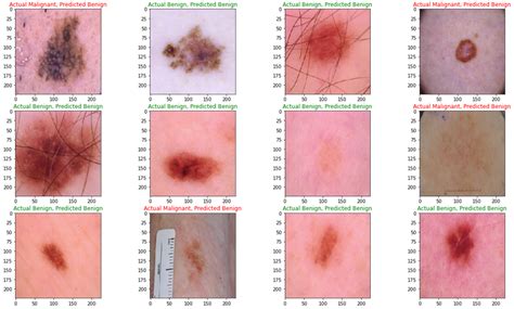 Github Abhishekopanda Skin Cancer Detection This Was My Final Project For Ee