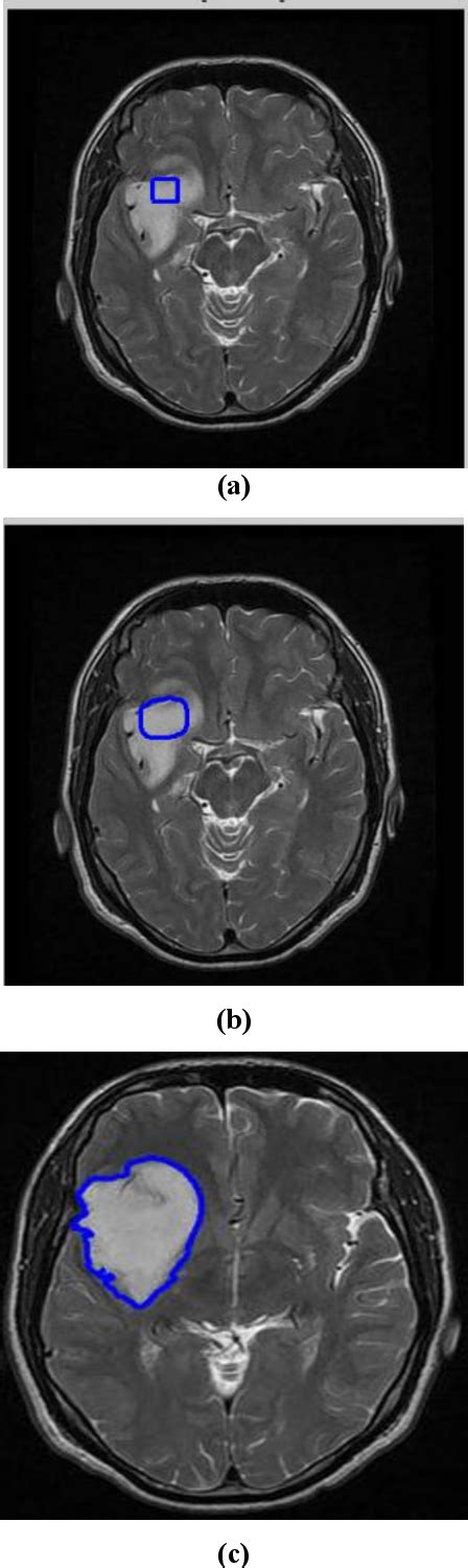 Figure 3 From A Novel Approach For Brain Tumor Segmentation Using Convolutional Neural Network