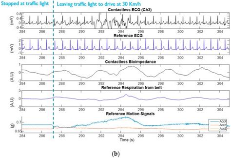 Physiological Driver Monitoring Using Capacitively Coupled And Radar Sensors