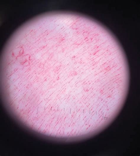Wiping Away Cellulitis A Case Of Factitious Disorder Mdedge Dermatology